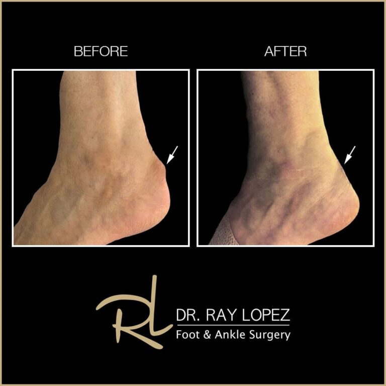 Peroneal Tendon Repair, Peroneus Brevis Tendon Surgery Miami